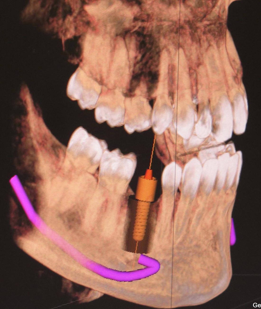 Barclay Downs, NC Dentist | Blog: Computer Guided Dental Implants
